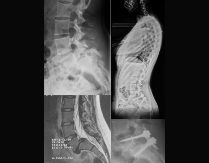 Spondylolisthésis - Centre Toulousain Du Rachis